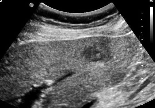Liver Cancer Ultrasound Liver Cancer