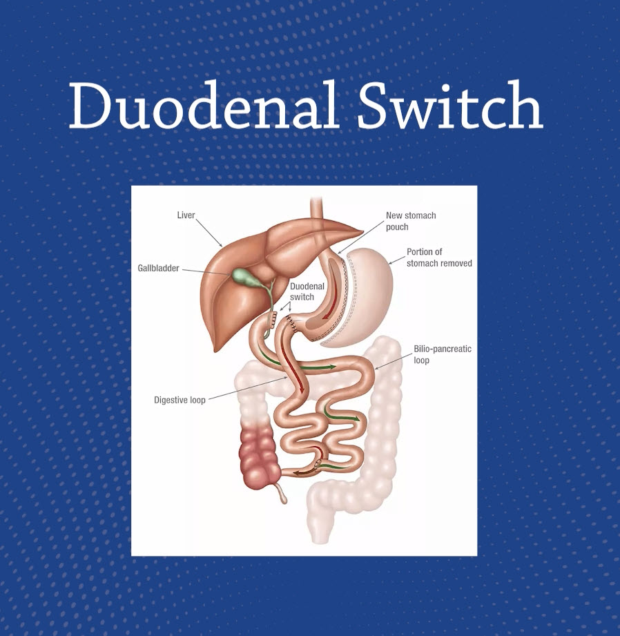 duodenal_switch.jpg