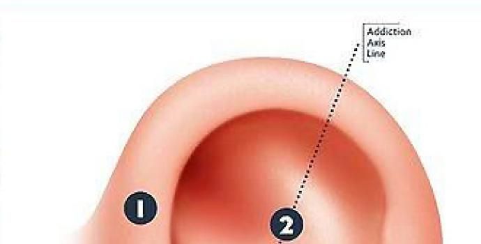 Listen In: Ear Acupuncture Resounds with Promise for Managing Pain ...