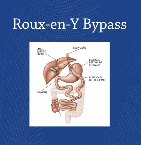 Who is the ideal candidate for the gastric bypass procedure?